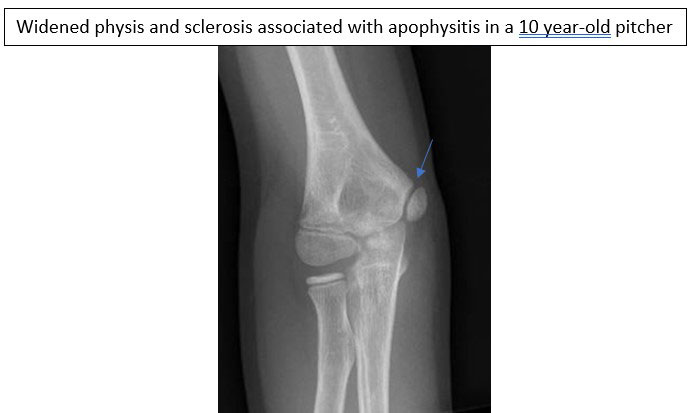 Medial Epicondyle Avulsion Fractures/Apophysitis | Elbow Surgery ...